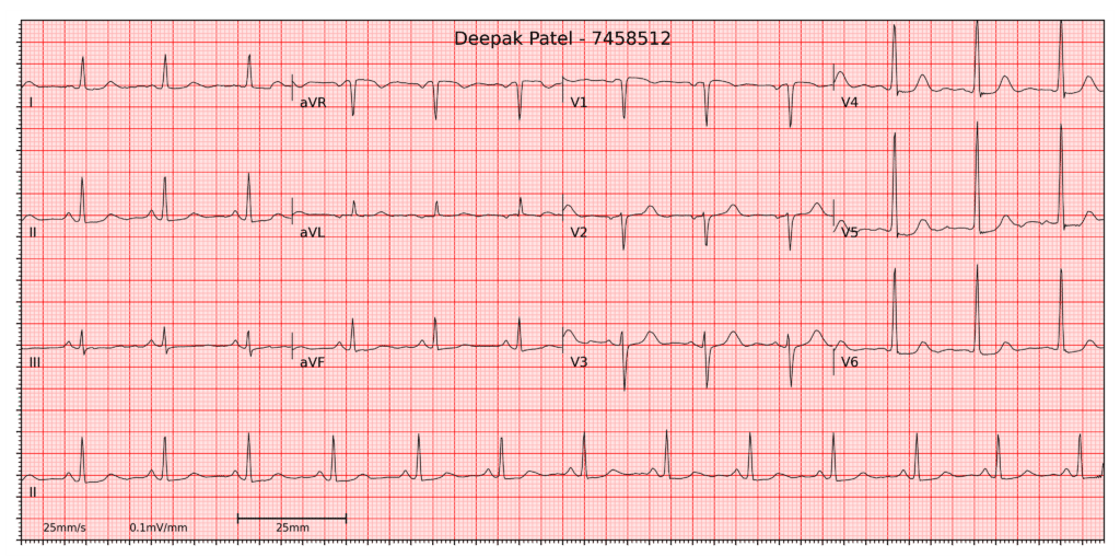 Angina [SIE003US] - Oxford Medical Simulation