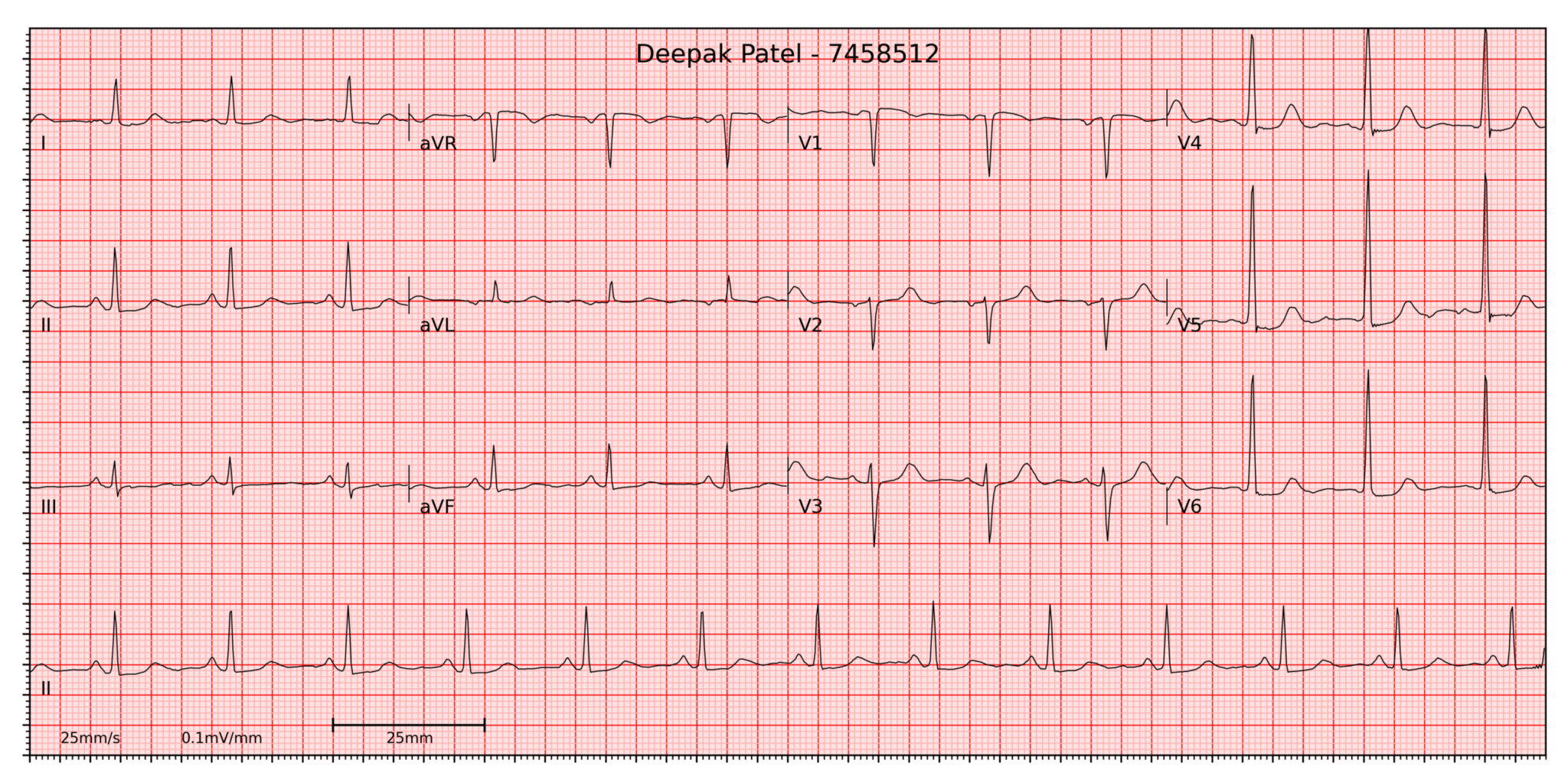 Angina [SIE003US] - Oxford Medical Simulation